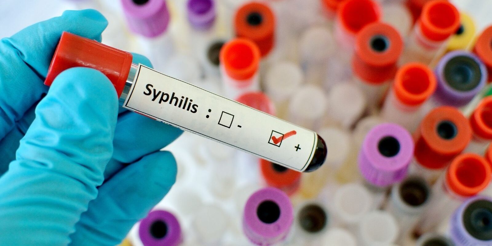 As syphilis cases skyrocket, free testing event is scheduled - Pigeon605
