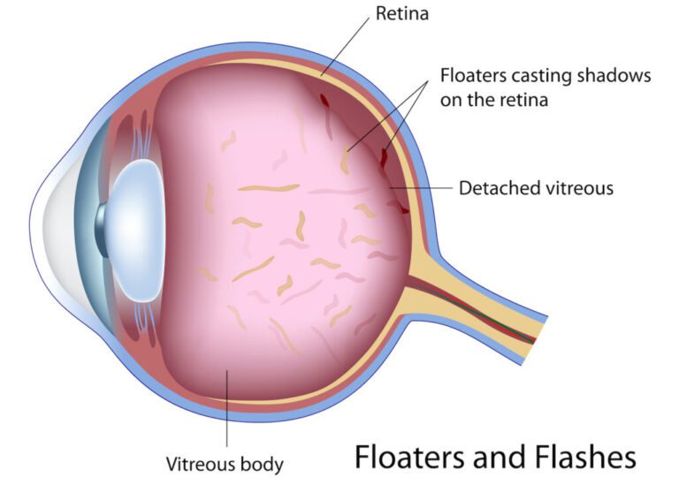 Seeing floaters in your vision? Here's what to know - Pigeon605