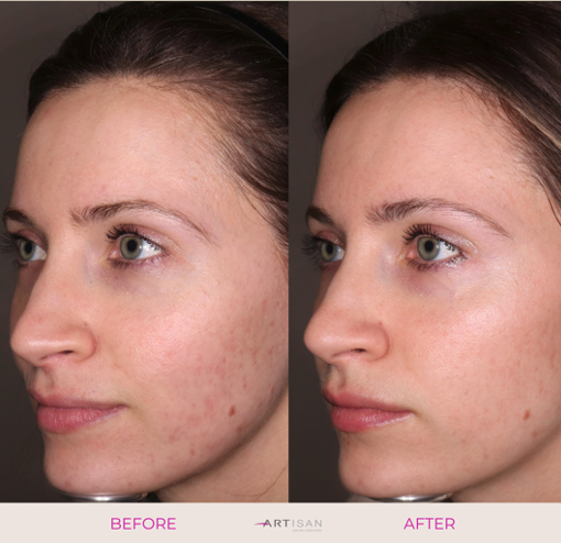 Welcome to the future of beauty: Revolutionary lasers for custom ...